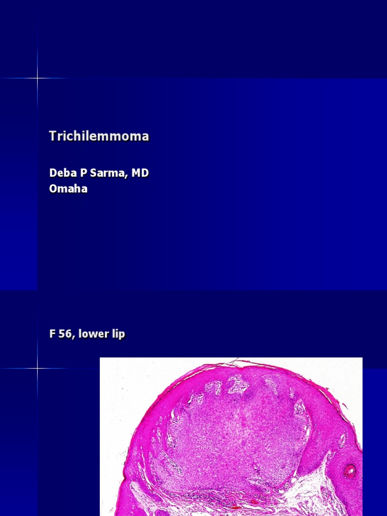 Trichilemmoma Diagnosis on Lower Lip | PDF