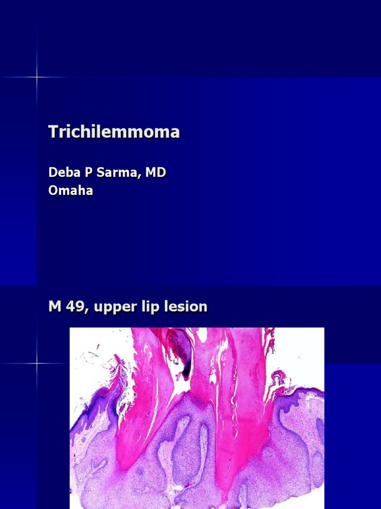 Trichilemmoma Overview and Characteristics | PDF