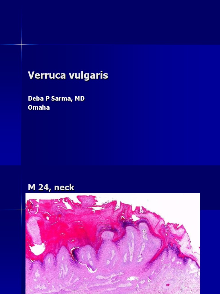 Verruca Vulgaris: Squamous Cell Lesion Analysis | PDF | Science ...