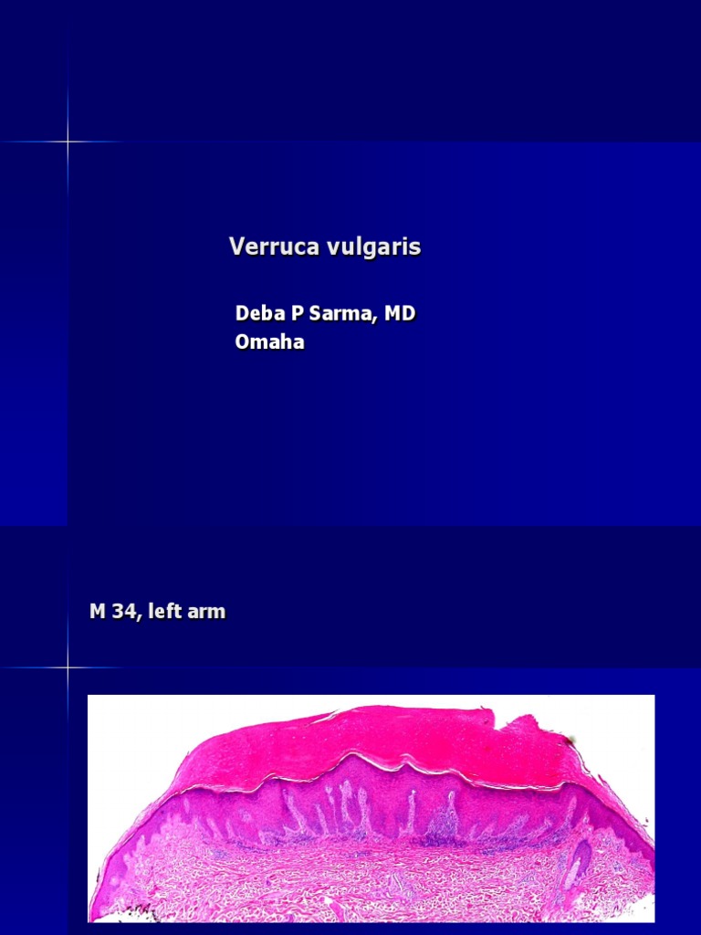 Verruca Vulgaris, M 34, Left Arm | PDF