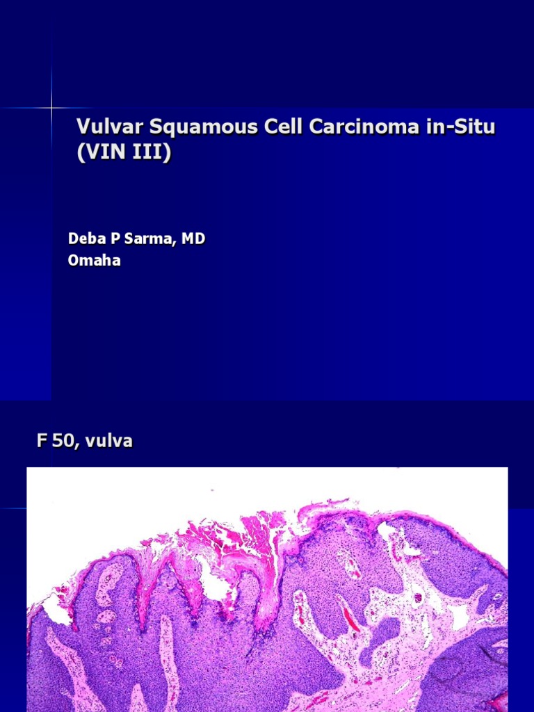 Understanding Vulvar Squamous Cell Carcinoma | PDF | Science & Mathematics