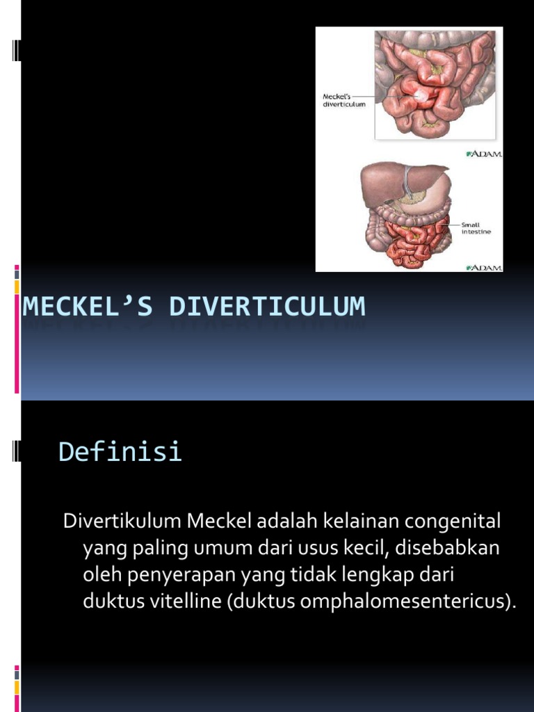 Meckel's Diverticulum | PDF