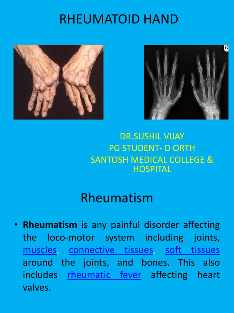 Rheumatoid Hands | PDF | Thumb | Rheumatoid Arthritis