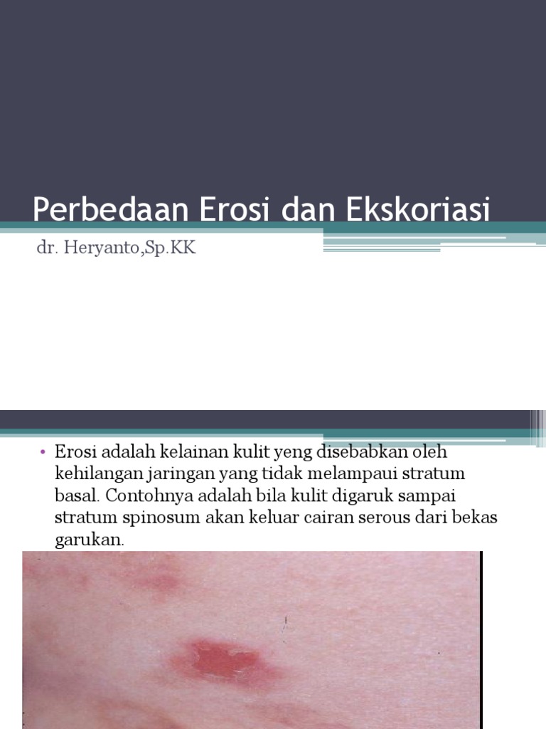 Perbedaan Erosi Dan Ekskoriasi | PDF