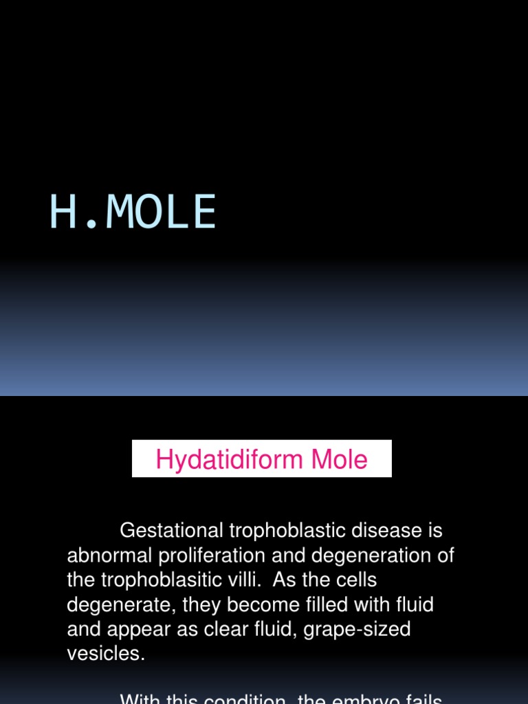 H-mole (case study) | Pregnancy | Miscarriage