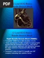 Delta Wave - LITFL Medical Blog - ECG Library Basics | PDF | Medical ...