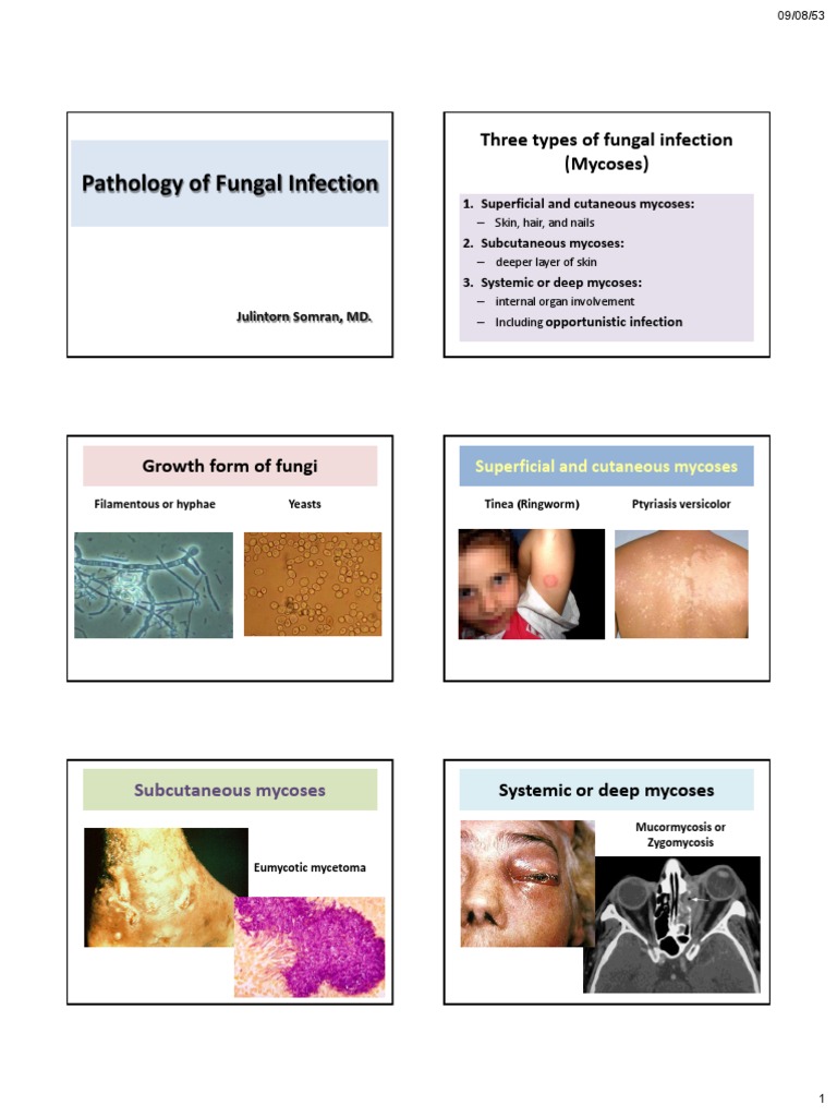Fungal Infection | Candidiasis | Infection