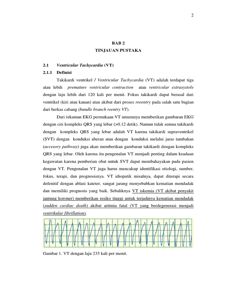 Lapkas Kardiologi - Ventricular Tachycardia CHF Ec Cad | PDF