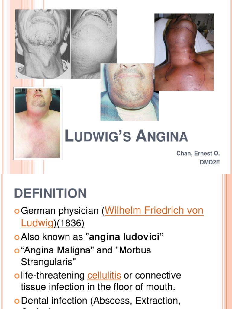 Ludwig's Angina | PDF