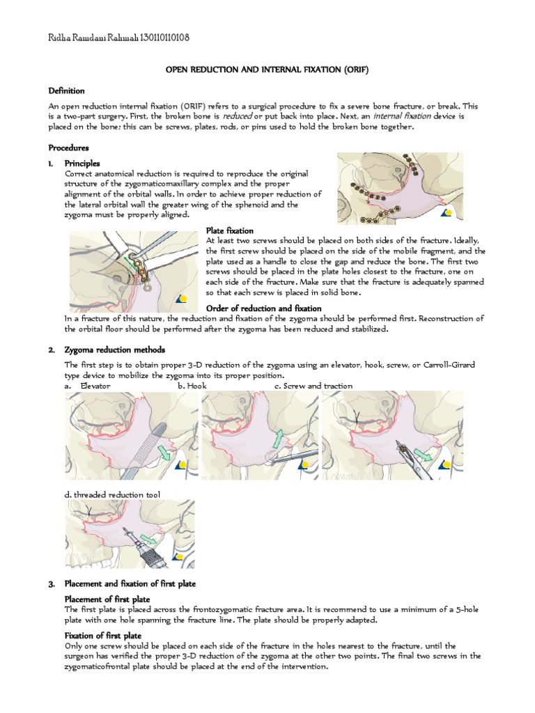 Open Reduction and Internal Fixation | PDF | Screw | Surgery