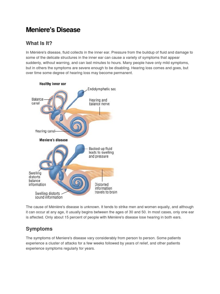 Meniere | PDF | Ménière's Disease | Vertigo