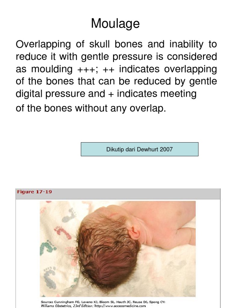 Molding and Caput Succedaneum Changes in Fetal Head Shape | PDF