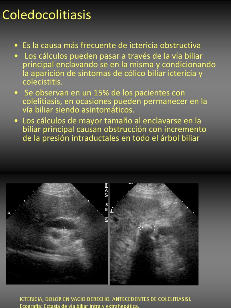 Coledocolitiasis | PDF | Viajes y turismo | Salud y bienestar