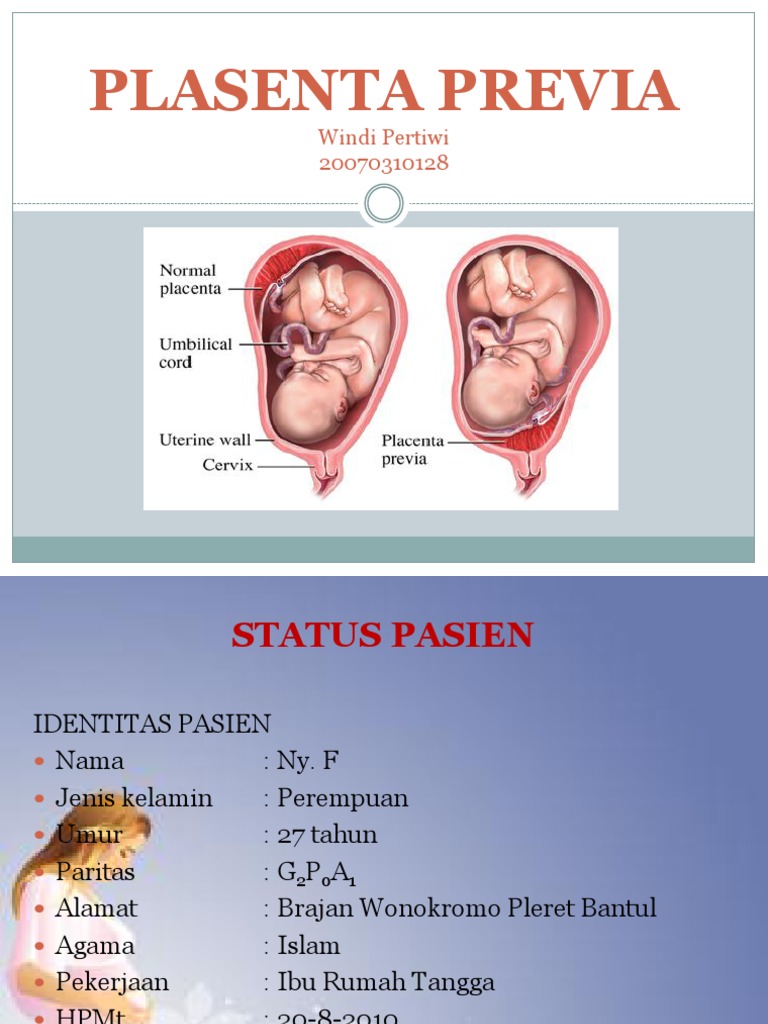 Plasenta Previa | PDF