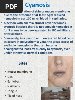 Peripheral Cyanosis In The Nail Beds