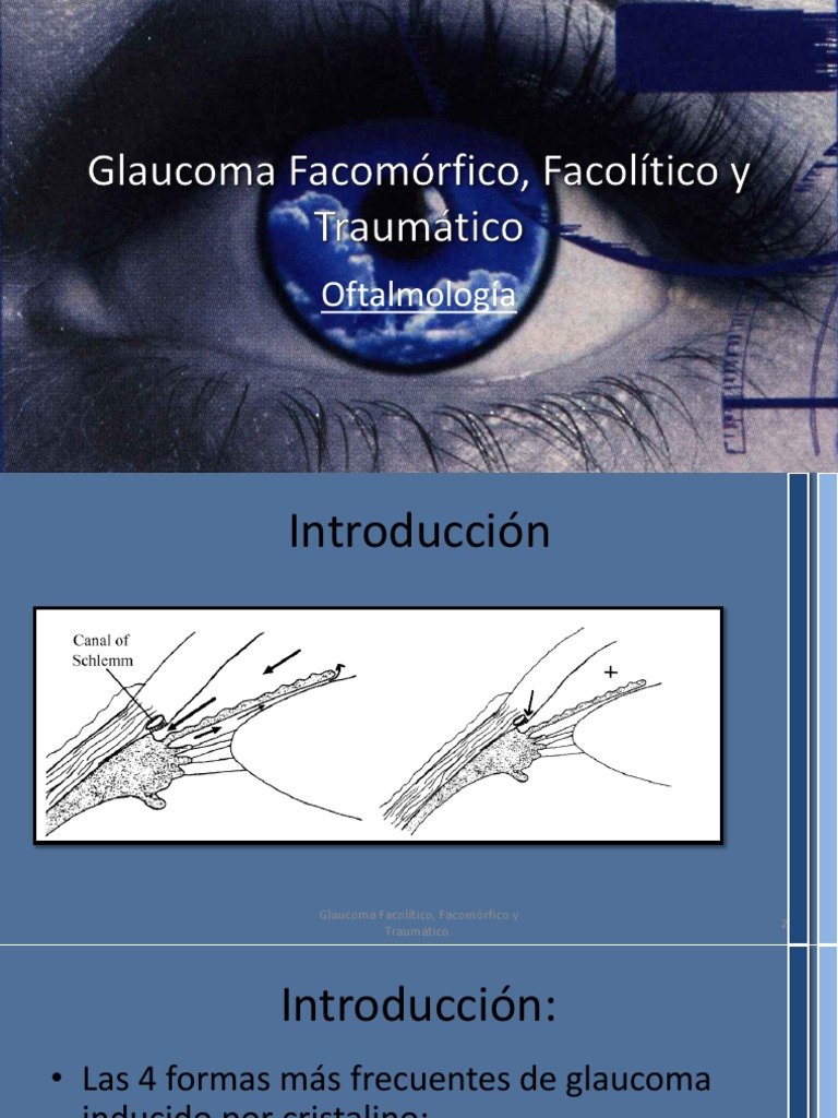 Glaucoma Facomórfico, Facolítico y Traumático | PDF | Catarata | Ojo humano