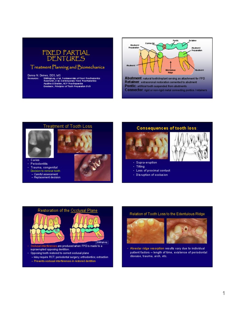 1 FP2 FPD Lecture 2011pdf | Dental Implant | Dentures