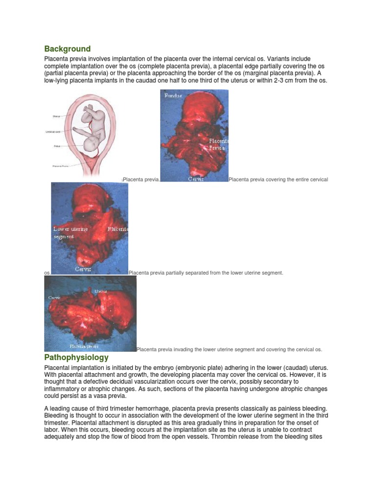 Background: Placenta Previa. Placenta Previa Covering The Entire ...