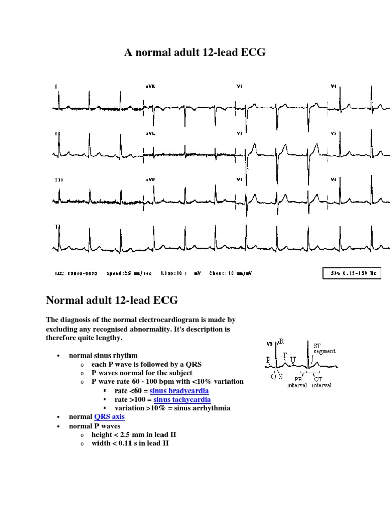A Normal Adult 12-Lead ECG: Sinus Bradycardia Sinus Tachycardia QRS ...