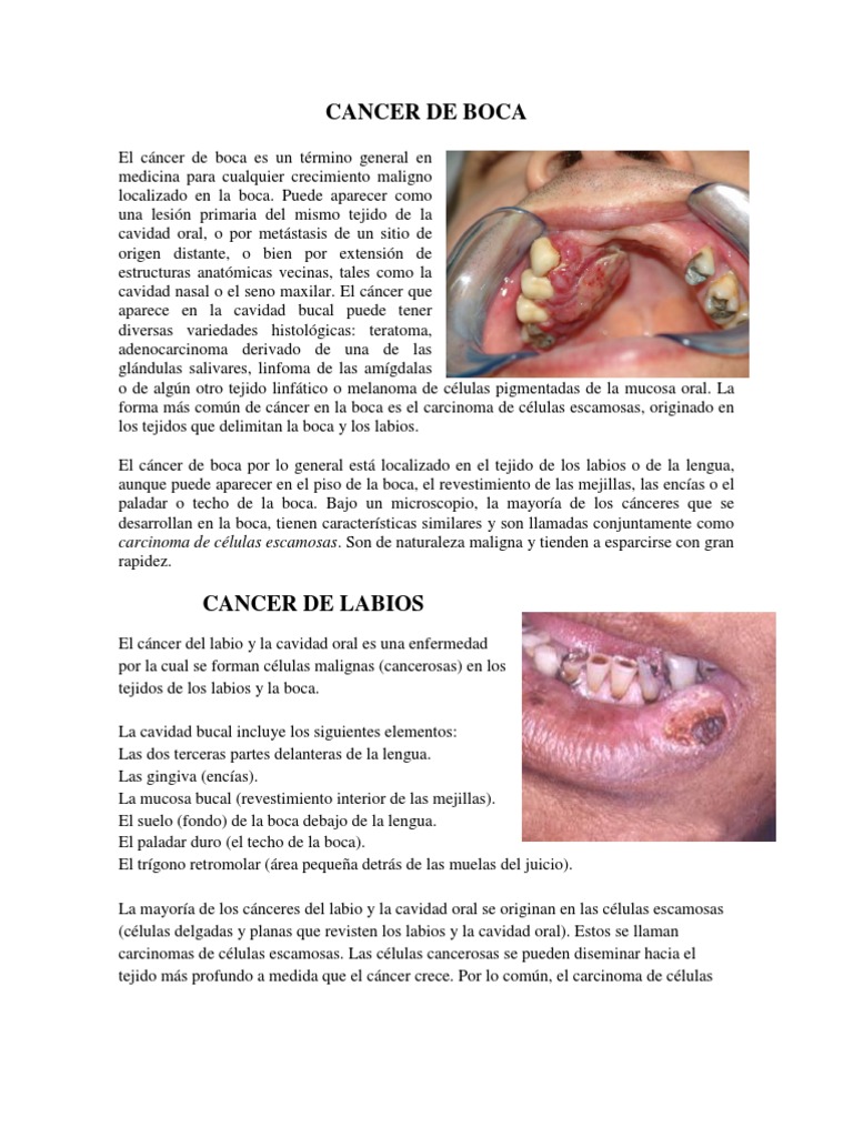 Cáncer de Boca: Tipos y Síntomas | PDF | Cáncer | Enfermedades y trastornos