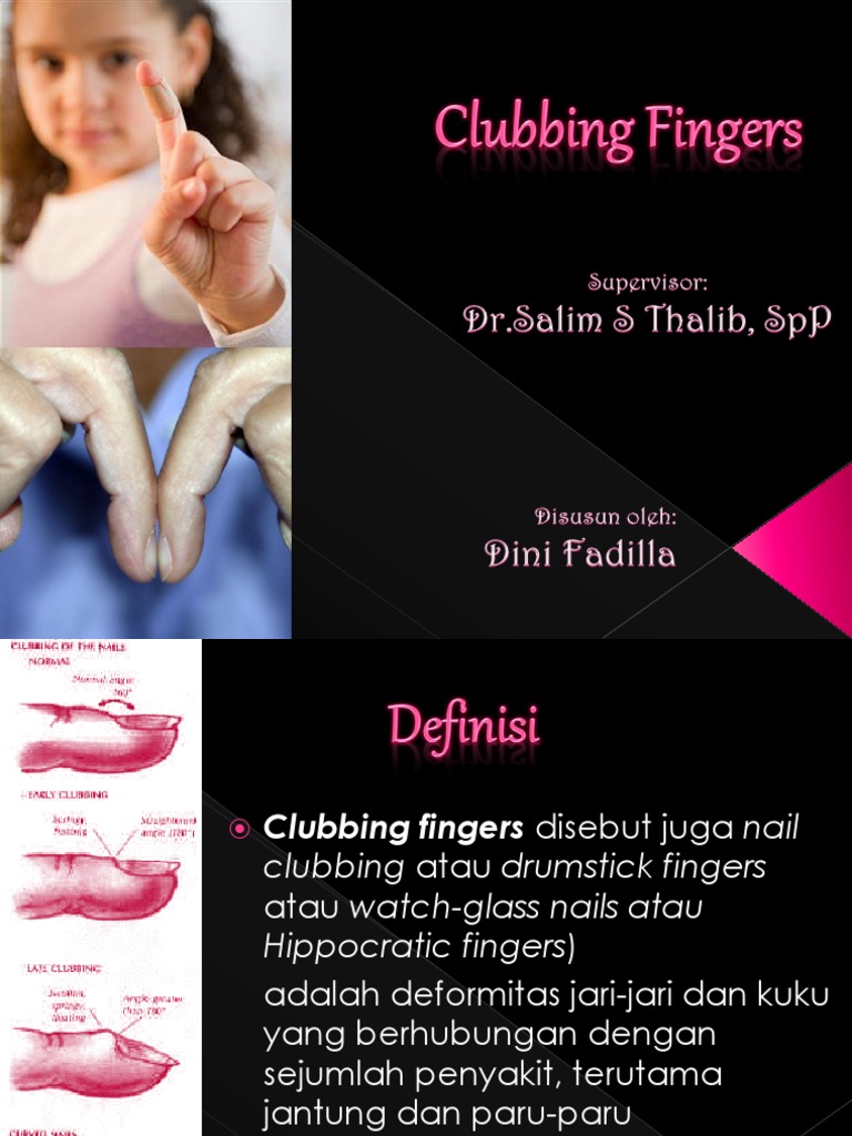Clubbing Fingers | PDF