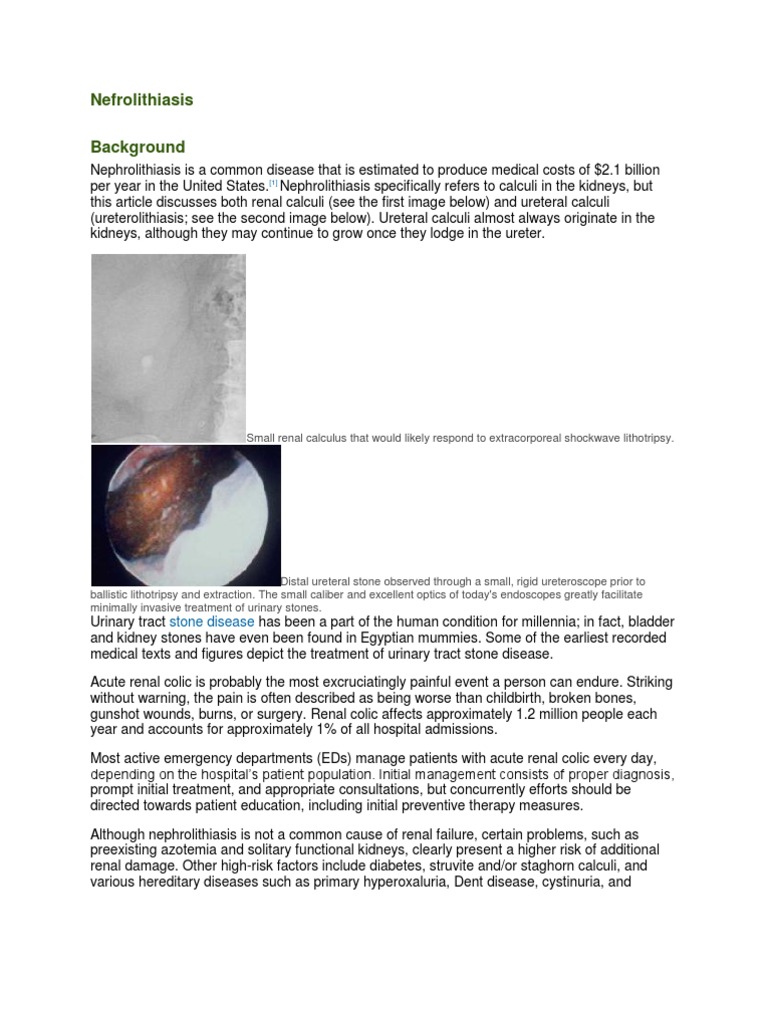 Nefrolithiasis | Kidney | Clinical Medicine