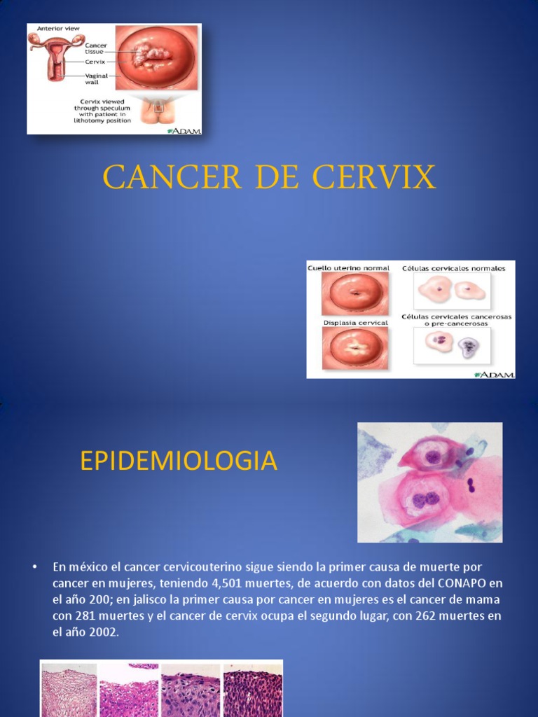 Cancer de Cervix | Cáncer de cuello uterino | Cáncer