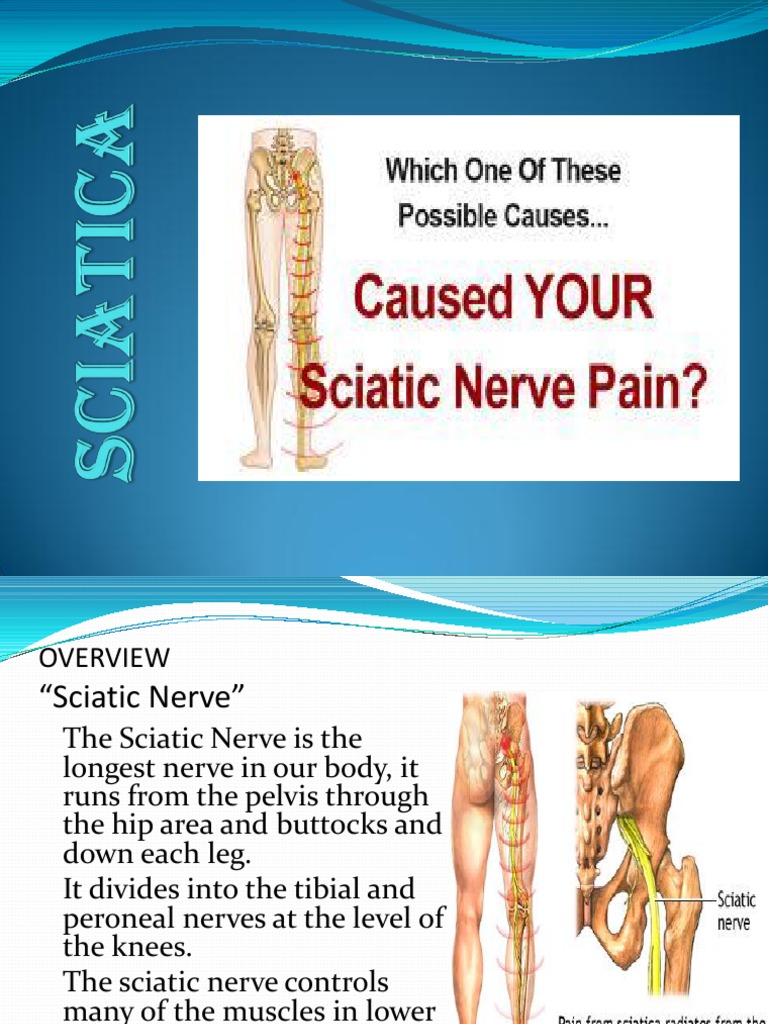 Sciatica | PDF | Diseases And Disorders | Neurological Disorders