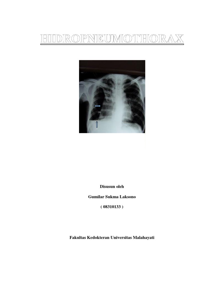 Hid Ro Pneumothorax | PDF