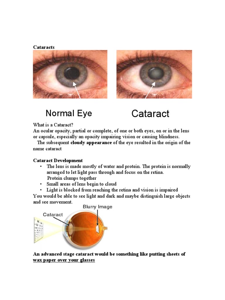 Catract.doc | Cataract | Visual Impairment