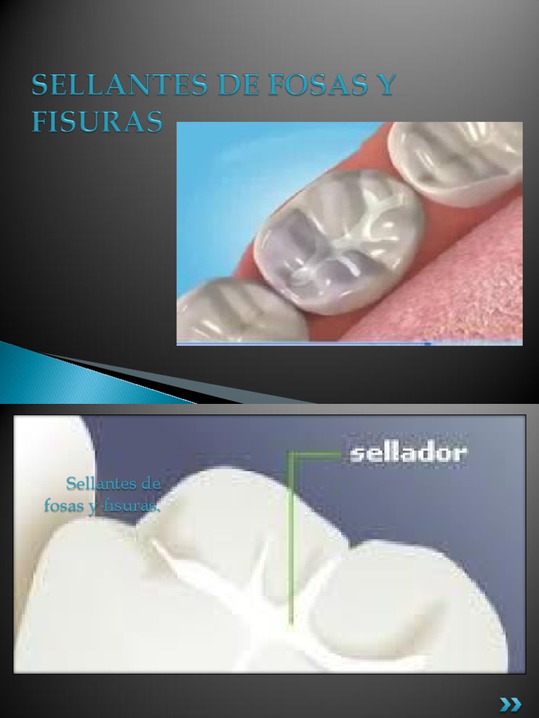 Sellantes de Fosas y Fisuras | Diente humano | Odontología