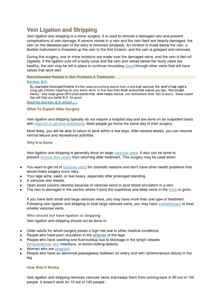 Vein Ligation and Stripping | PDF | Varicose Veins | Vein