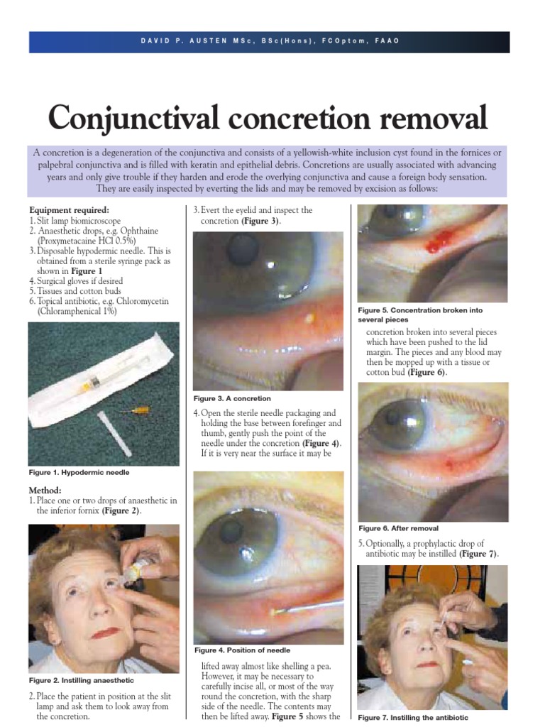 Ocular Lithiasis | PDF | Optometry | Health Sciences