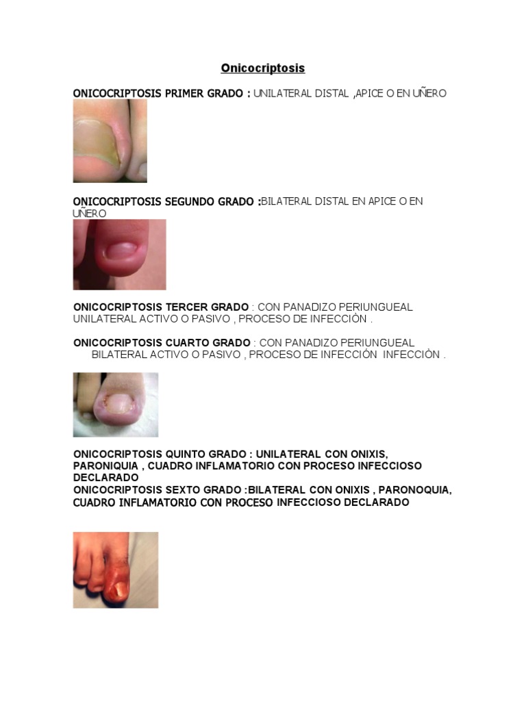 Grados Onicocriptosis | PDF