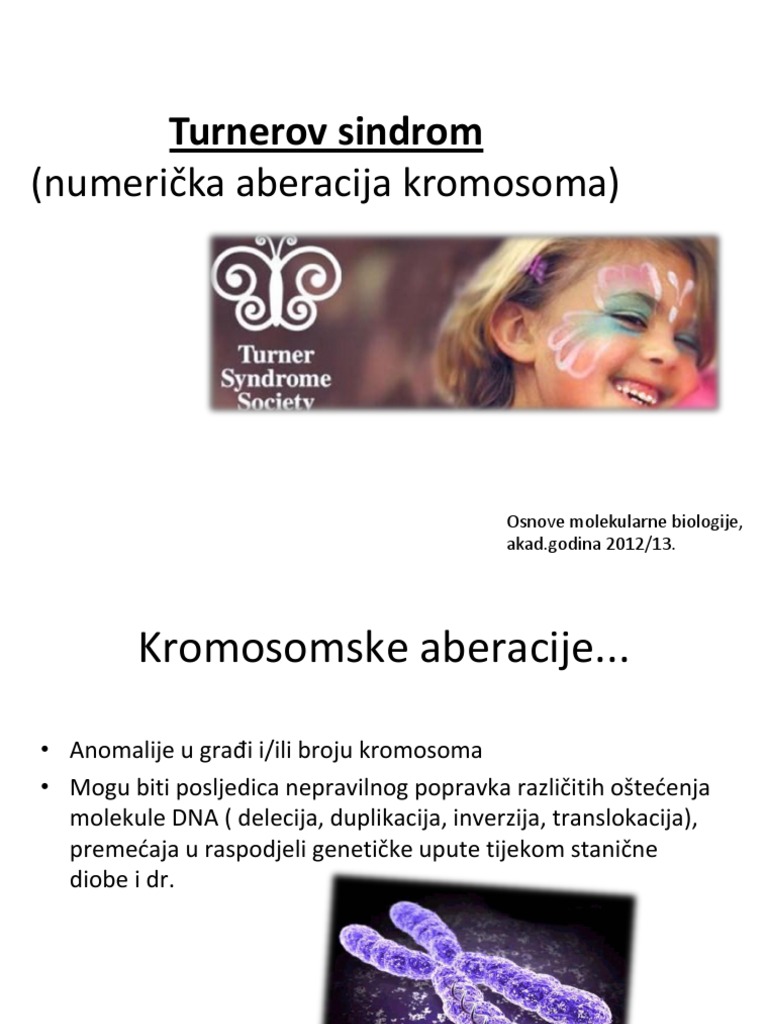 Turnerov Sindrom 2003 | PDF