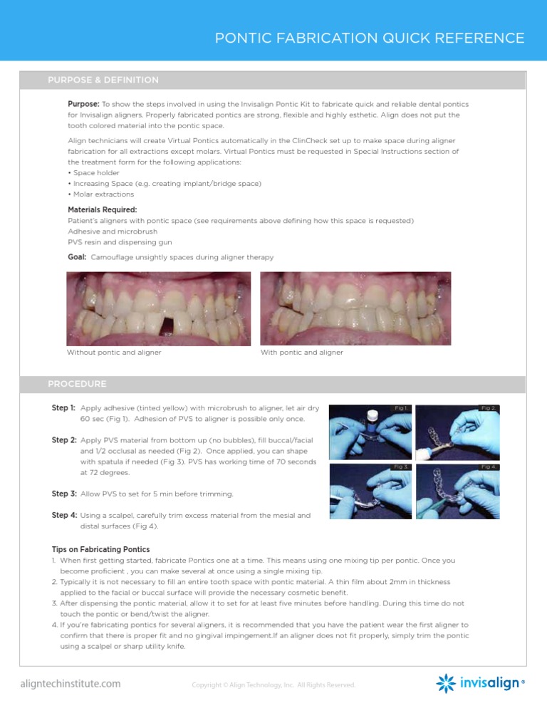 Pontic | PDF | Dentistry Branches | Mouth