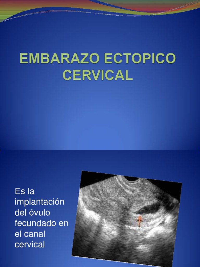 Embarazo Ectopico Cervical 1 | PDF | Salud maternal | Obstetricia
