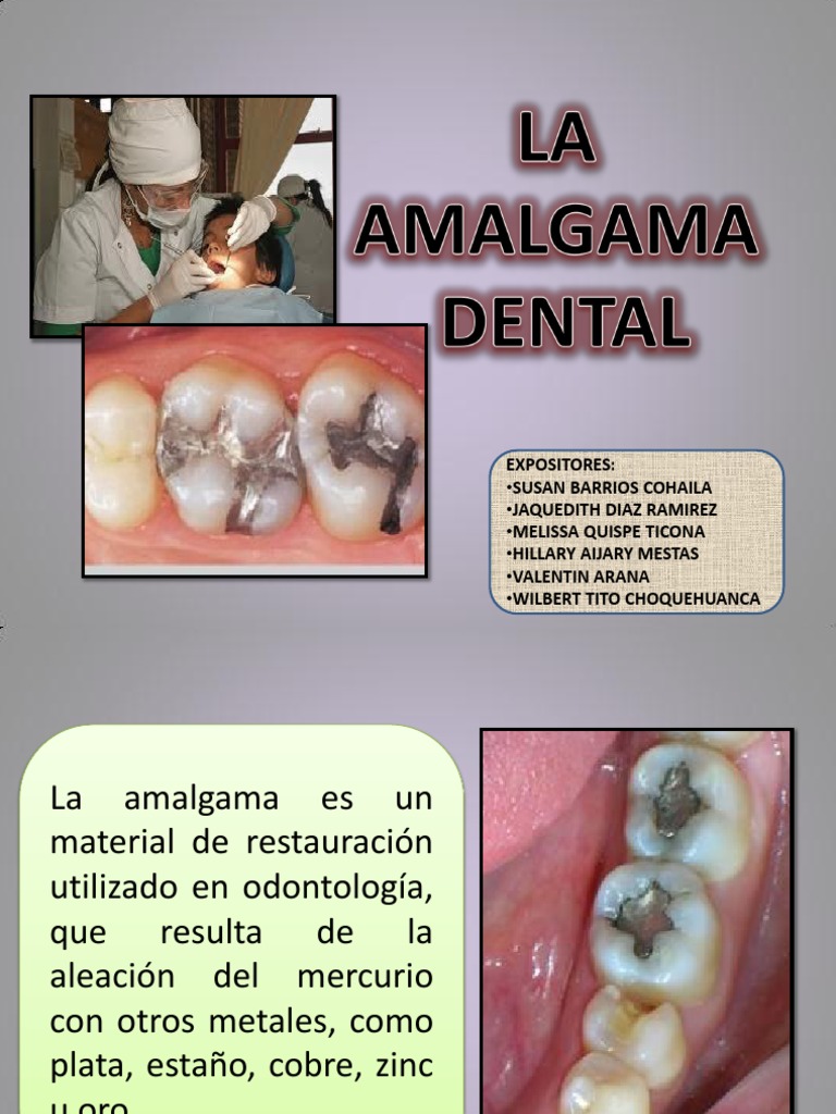 AMALGAMA MATERIALES DENTALES | Mercurio (Elemento) | Corrosión