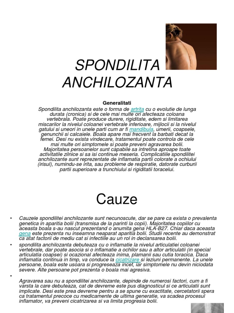 Spondilita Anchilozanta | PDF