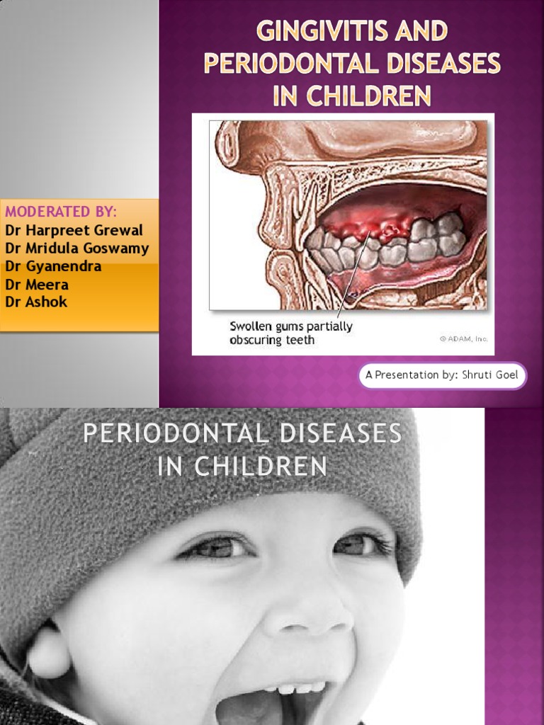 Understanding Early-Onset Periodontitis | PDF