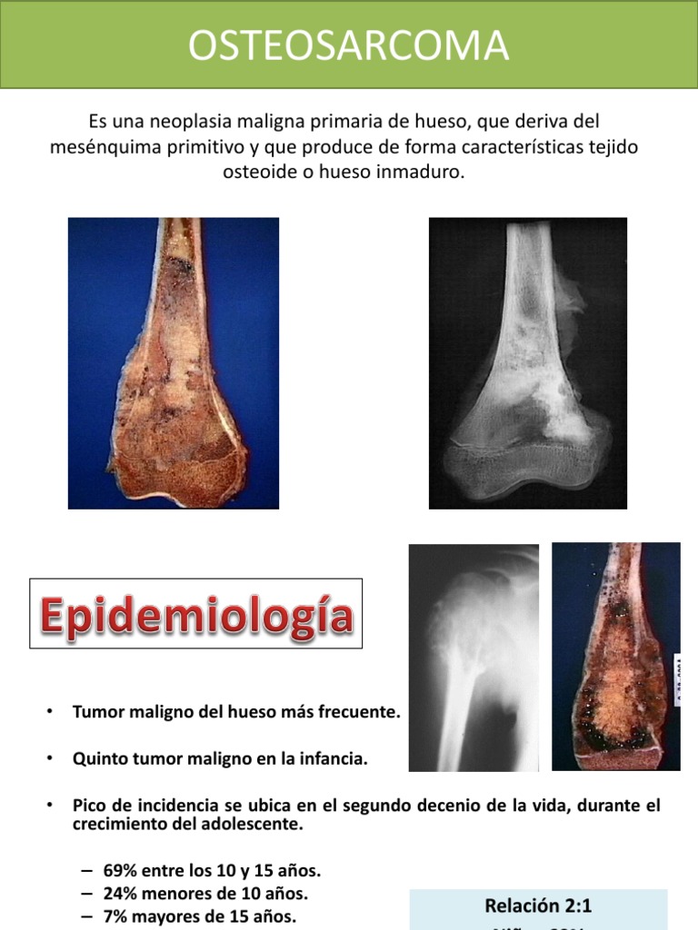 Osteosarcoma | PDF | Hueso | Metástasis