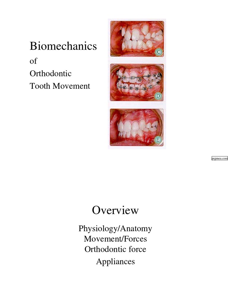 Biomechanics: of Orthodontic Tooth Movement | PDF