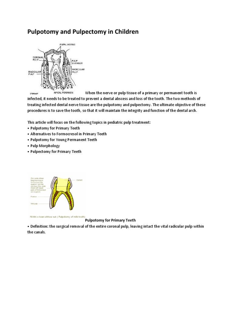 Pulpotomy and Pulpectomy in Children: Pulpotomy For Primary Teeth | PDF ...