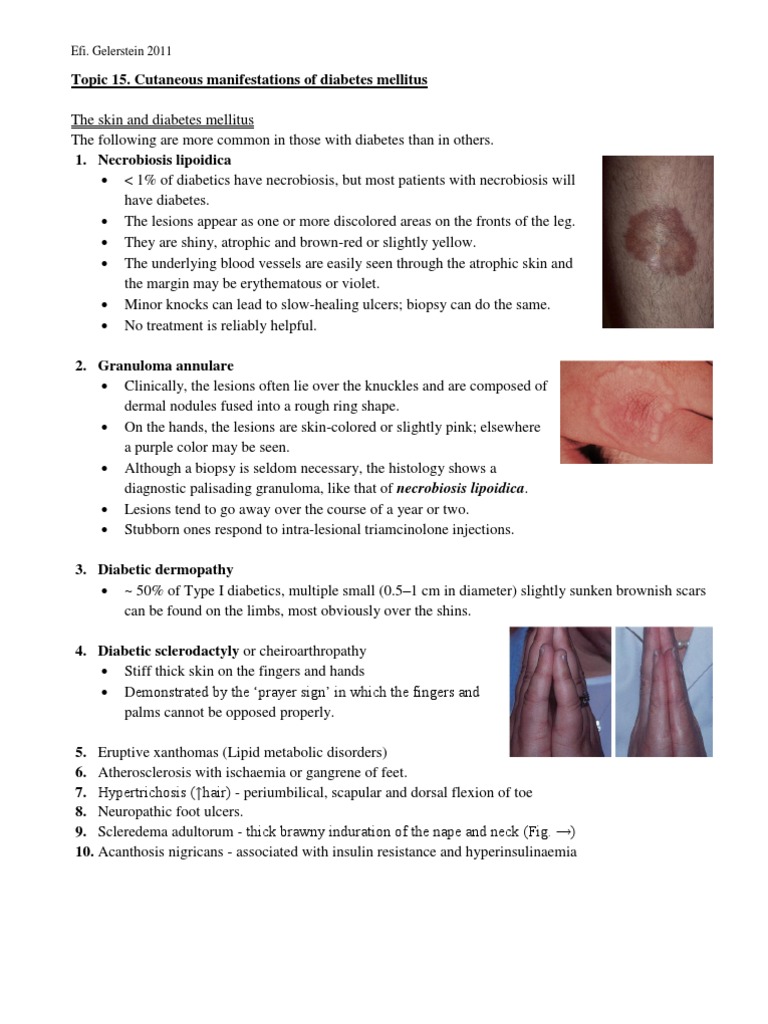 Topic 15. Cutaneous Manifestations of Diabetes Mellitus | Cutaneous ...