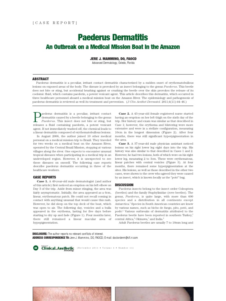 Paederus Dermatitis An Outbreak On A Medical Mission Amazon | PDF ...