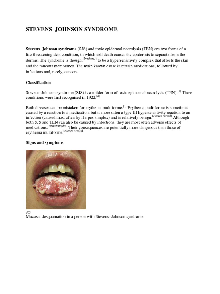 Stevens Johnson Disease | PDF