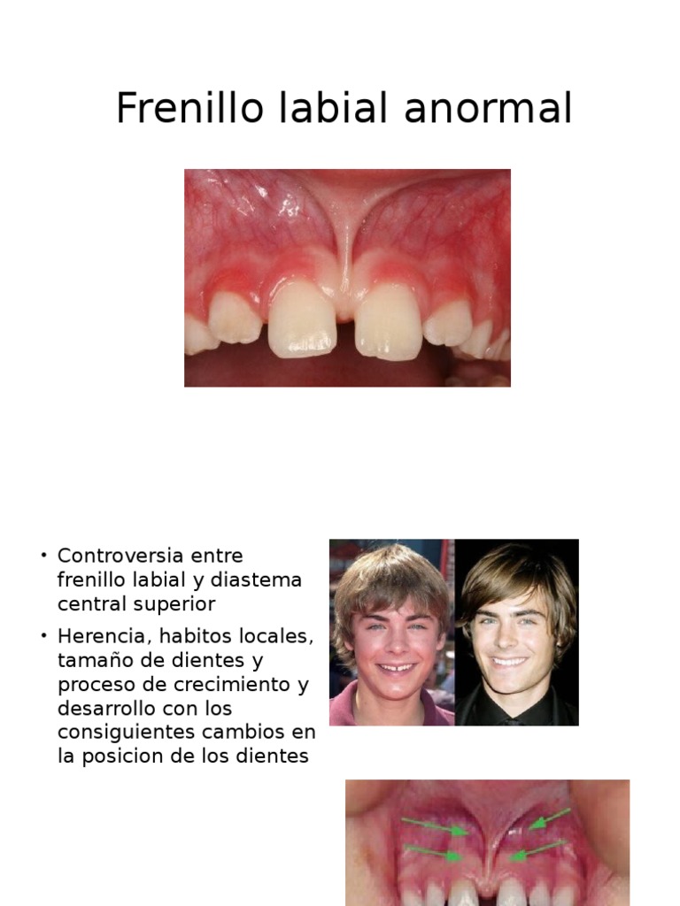 Frenillo labial anormal y diastemas | PDF