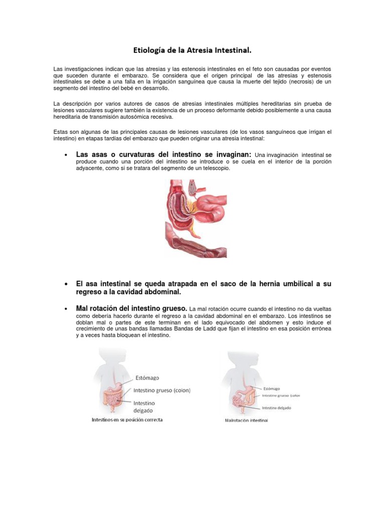 Etiología de La Atresia Intestinal | PDF | Abdomen | El embarazo