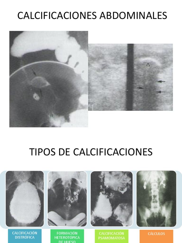 CALCIFICACIONES ABDOMINALES | Peritoneo | Abdomen