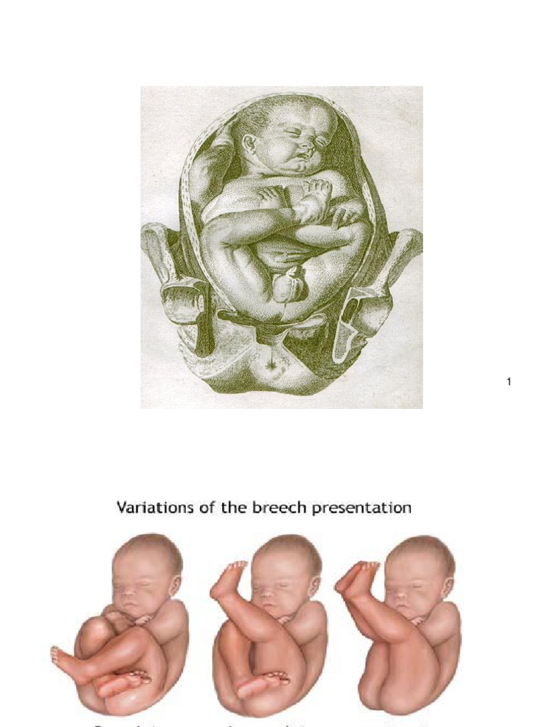 Breech Presentation | PDF | Pelvis | Childbirth